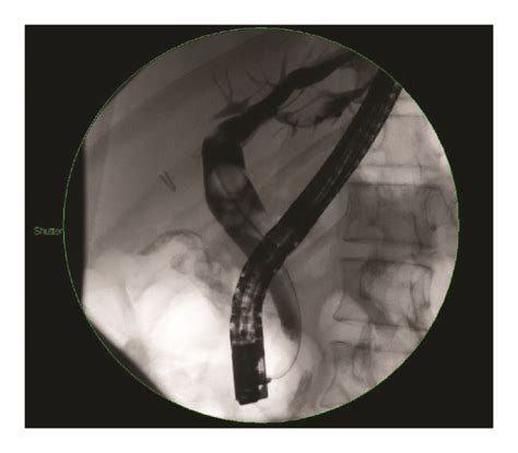 ERCP Showing Multiple CBD Stones Note That The Right Hepatic Duct Is Download Scientific