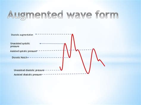 Iabp Wave Forms