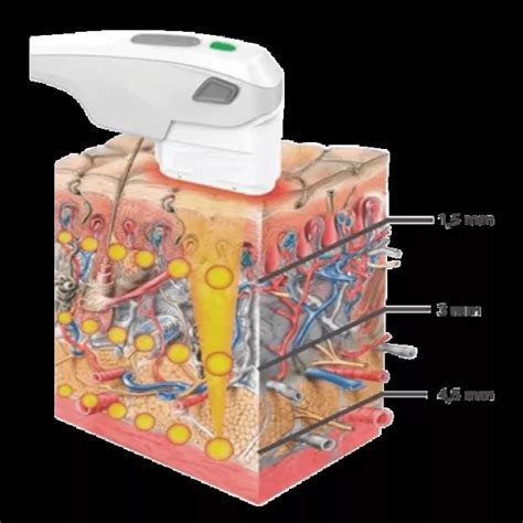 Hifu Device For Skin Therapists Neocure
