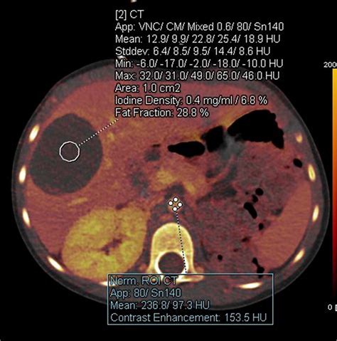 Dual Energy Ct Material Decomposition In Pediatric Thoracic Oncology Radiology Imaging Cancer