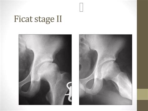Avascular Necrosis Of Femoral Head Classification Ppt