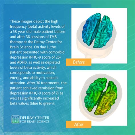 Tms Resuls Delray Brain Science
