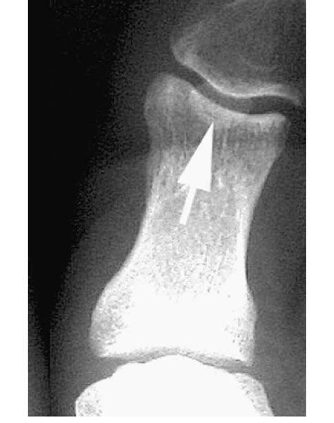 Dorsoplantar Radiograph Shows Hallux Interphalangeal Sesamoid Bone