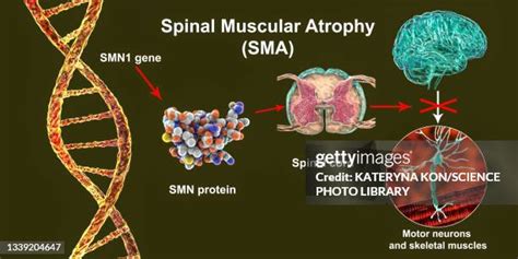 Sma Disease Photos And Premium High Res Pictures Getty Images