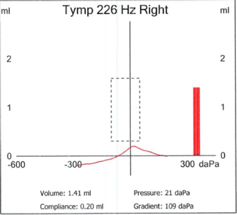 Tympanometry What It Is And Types Of Tympanogram Readings Tympanometry What It Is And Types Of Tympanogram Readings