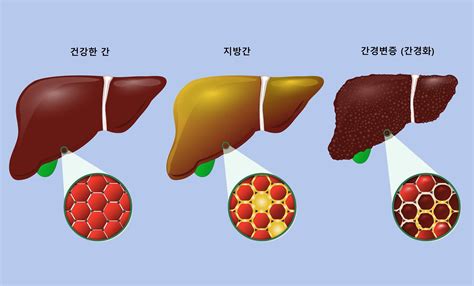 [단독] 판결 메리츠화재 소송으로 말기 간경화 진단비 안 주려고 버티다 패소 Lawpipl Com