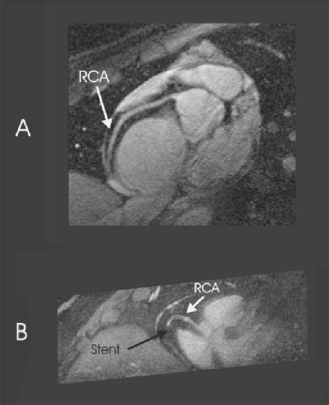 Figure 7 From Spatial Encoding Using Multiple Rf Coils Smash Imaging And Parallel Mri