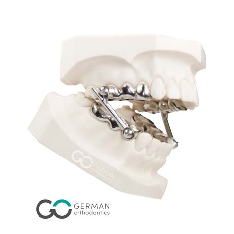 Herbst Appliance German Orthodontics