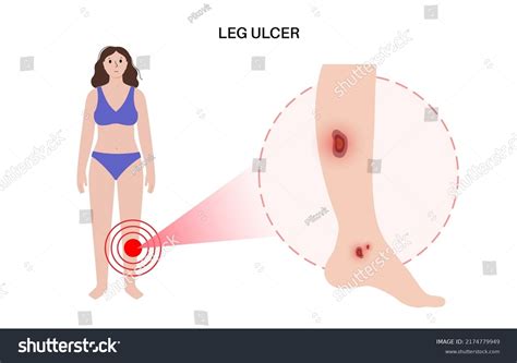 Venous Ulcer Diagram