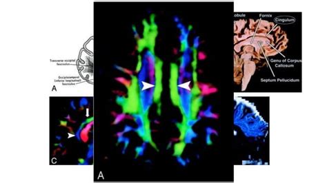 Diffusion Tensor Imaging Pptx