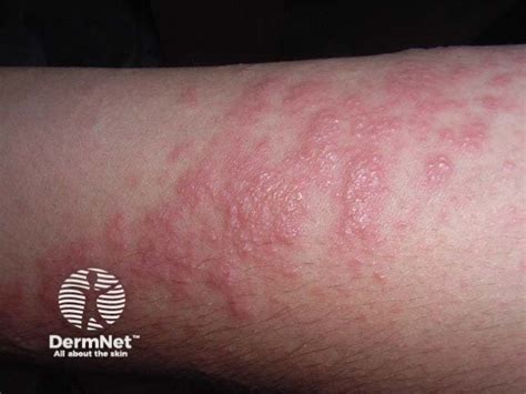 Dermatitis Photosensitivity Dermatitis