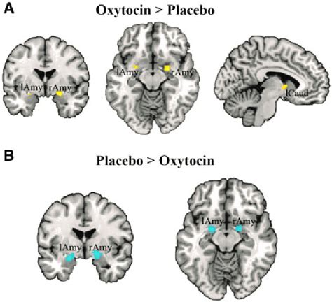 General Neural Effects Of Intranasal Administration Of Oxytocin A