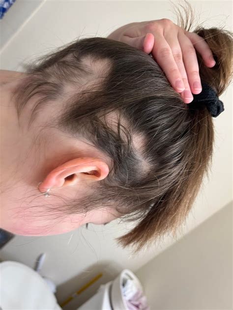 Anyone With Success Treating Ophiasis R Alopecia Areata