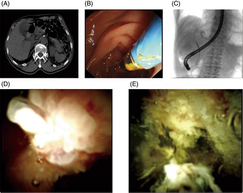 Digital Single‐operator Cholangioscopy‐guided Endoluminal