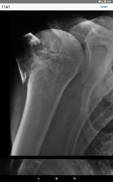 Aoota Fracture Classification Apk Pour Android Télécharger