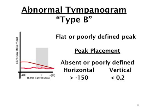 Type B Flat Tympanogram At Karan Katz Blog