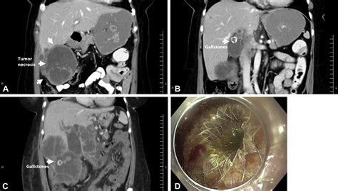 Gallstones Migration From Ruptured Gallbladder To Necrotic Tumor Cavity After Metallic Stent