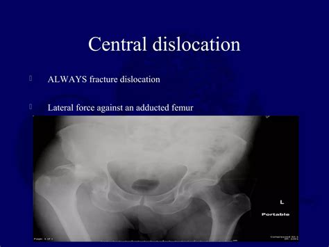 Hip Dislocation Class Ppt