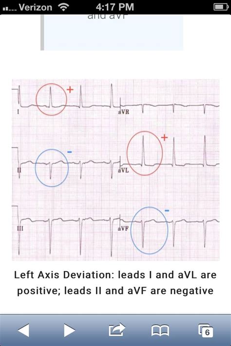 Pin On Nursing Electrophysiology