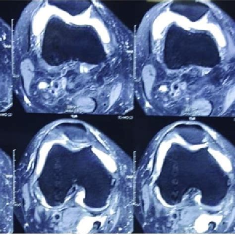 Mri Showing Synovitis Of The Left Knee Download Scientific Diagram