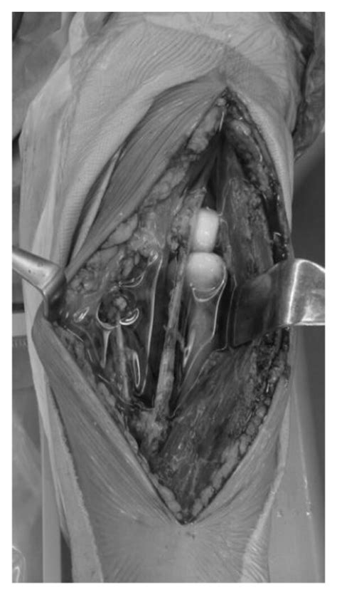 A 23 Year Old Female With A Synovial Sarcoma On The Left Elbow Joint