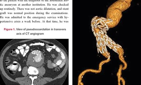 Figure 1 From Aortic Rupture Due To Pseudocoarctation Caused By Migrated Stent Graft Semantic