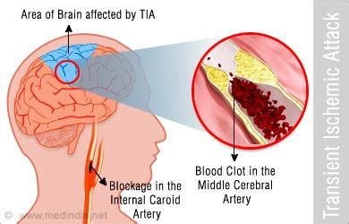 Transient Ischemic Attack Risk Factors Symptoms Diagnosis Treatment Faqs