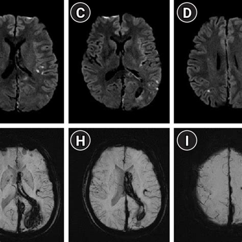 Initial Brain Magnetic Resonance Imaging Shows Multiple Embolic Download Scientific Diagram