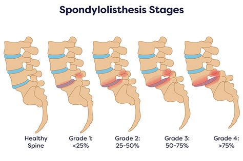 Spondylolisthesis Treatment In Nj And Nyc