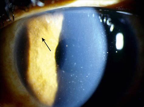 Fuchs Uveitis Syndrome Clinical Tree