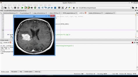 Densetrans Multimodal Brain Tumor Segmentation Using Swin Transformer Youtube