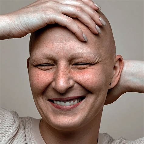 Alopecia Treatment You Hair Solution Mc Scalp