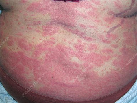 Erythrodermic Psoriasis Stock Image C0565502 Science Photo Library