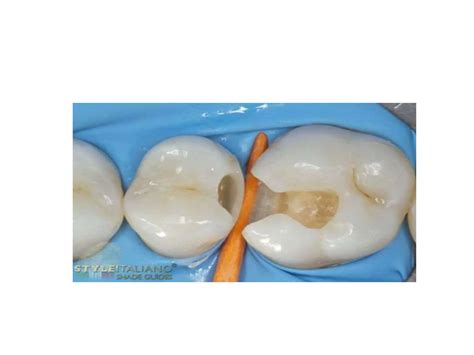 Class Ii Cavity Preparation Pptx