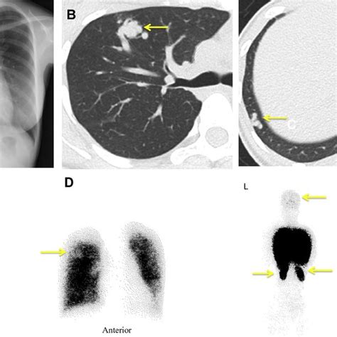 A Chest Ct Scan Upper And Reconstructed Sagittal Image Lower