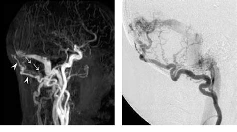 Table 1 From Time Resolved 3d Mra Applications For Interventional