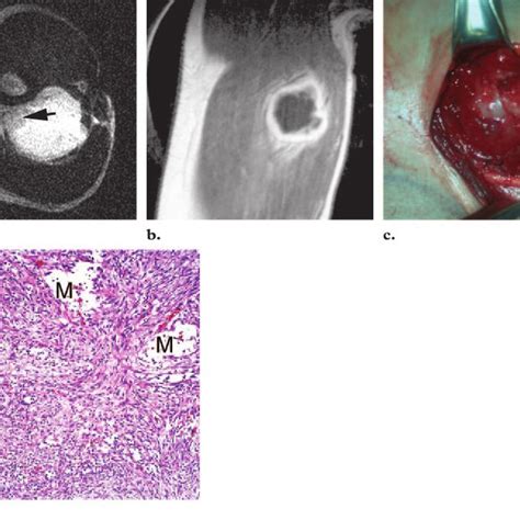 Subcutaneous Fascia Based Nodular Fasciitis In The Upper Arm Of A Download Scientific Diagram