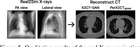 Pdf Perspective Projection Based 3d Ct Reconstruction From Biplanar X Rays Semantic Scholar