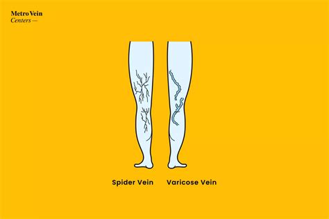 Discover The Latest Innovations In Varicose Vein And Spider Vein