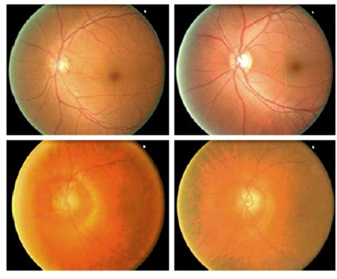 Figure From An Automated Glaucoma Detection From Fundus Images Based On Deep Learning Network