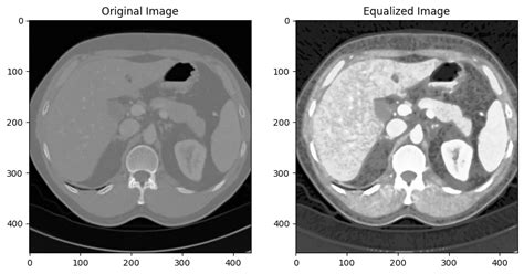 Enhancing Medical Image Quality Using Histogram Equalization By Uma Mahesvari Medium