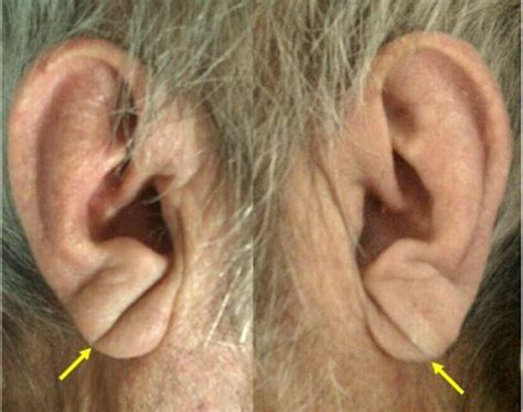 Franks Sign Also Known As The Diagonal Earlobe Crease Delc Is A