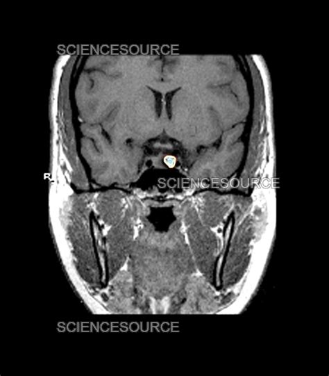 Pituitary Gland Lesion Stock Image Science Source Images