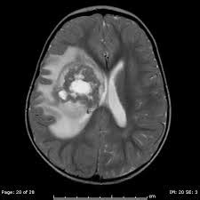Brain Tumour Images IEEE DataPort