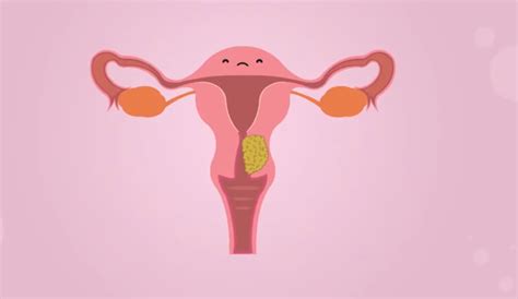 Các giai đoạn của ung thư cổ tử cung bạn cần biết Các giai đoạn của ung thư cổ tử cung bạn cần