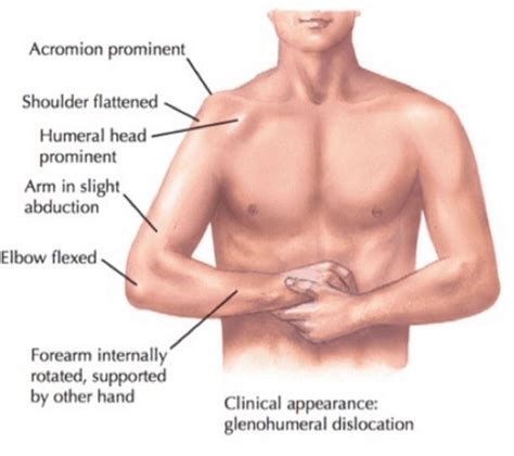 How To Prevent Anterior Shoulder Dislocation In Youth Athletes