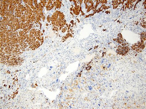 Pathology Outlines Leiomyosarcoma General