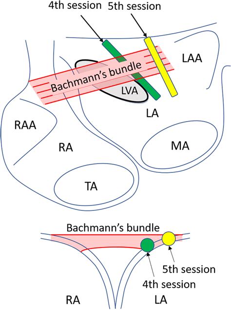 A Schema Of The Relationship Between The Ablation Lesions And