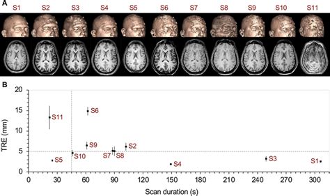 Development Of An Ultrafast Brain Mr Neuronavigation Protocol For Ventricular Shunt Placement Pmc