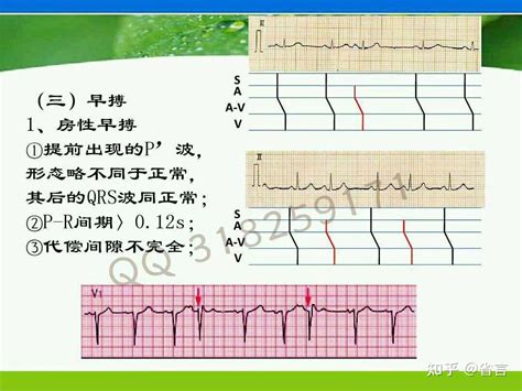 医学生笔记心电图基础知识个人笔记仅供参考 知乎